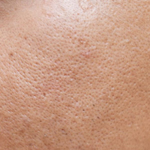 Pore Reduction in Vancouver WA - Corona Clinic